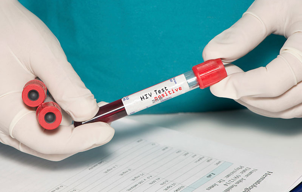 When to Test for HIV? Importance of Early HIV Diagnosis